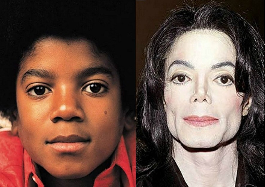 Michael Jackson Vitiligo: The Full Medical Story | VitiligoMart